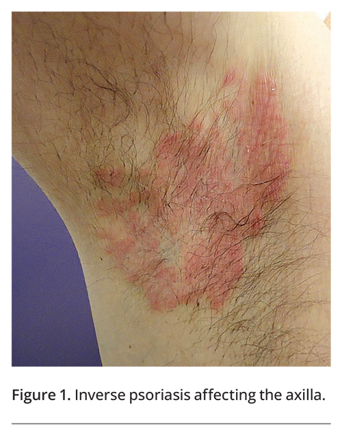 Intertriginous skin disorders: what’s lurking where? | Medicine Today